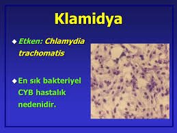 Klamidya Nedir Tedavisi Nasıl Yapılır